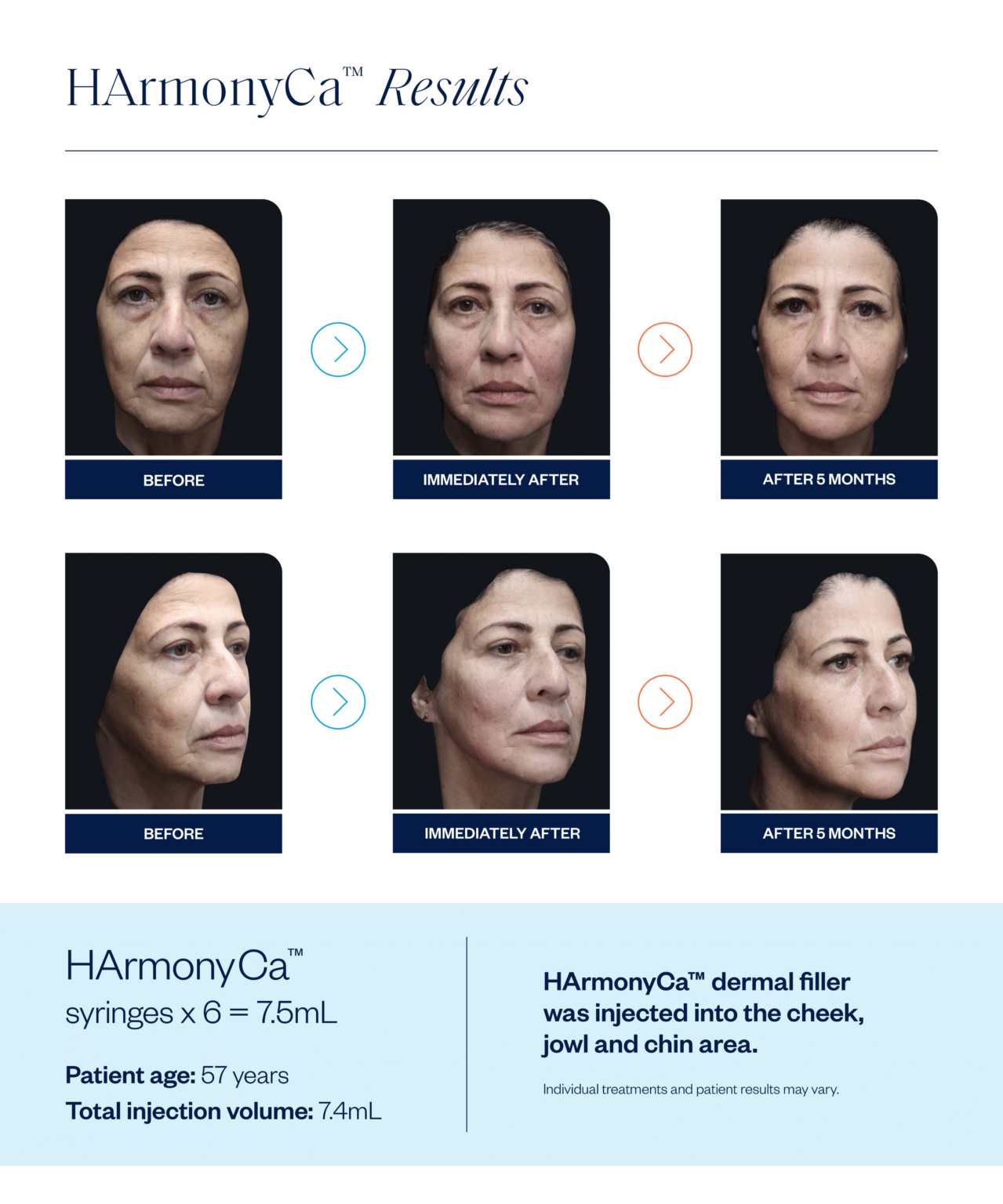 HArmonyCA ทำไมถึงเป็น Hybrid Filler มีคุณสมบัติเด่นในเรื่องอะไร