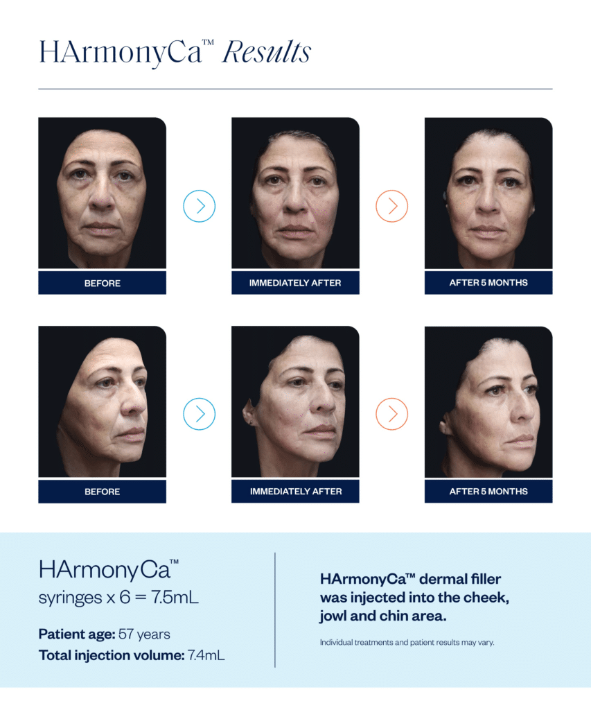 HArmonyCA ทำไมถึงเป็น Hybrid Filler มีคุณสมบัติเด่นในเรื่องอะไร