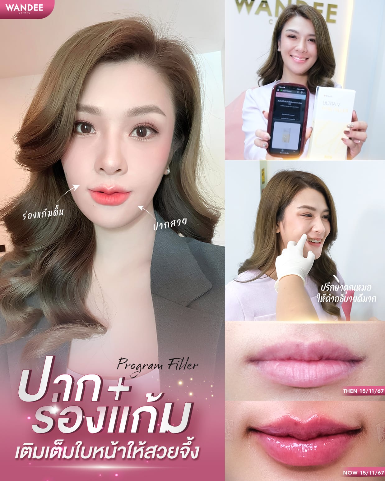 แก้มเต็ม ปากสวย หน้าดูพรีเมียมเพราะ Program Filler