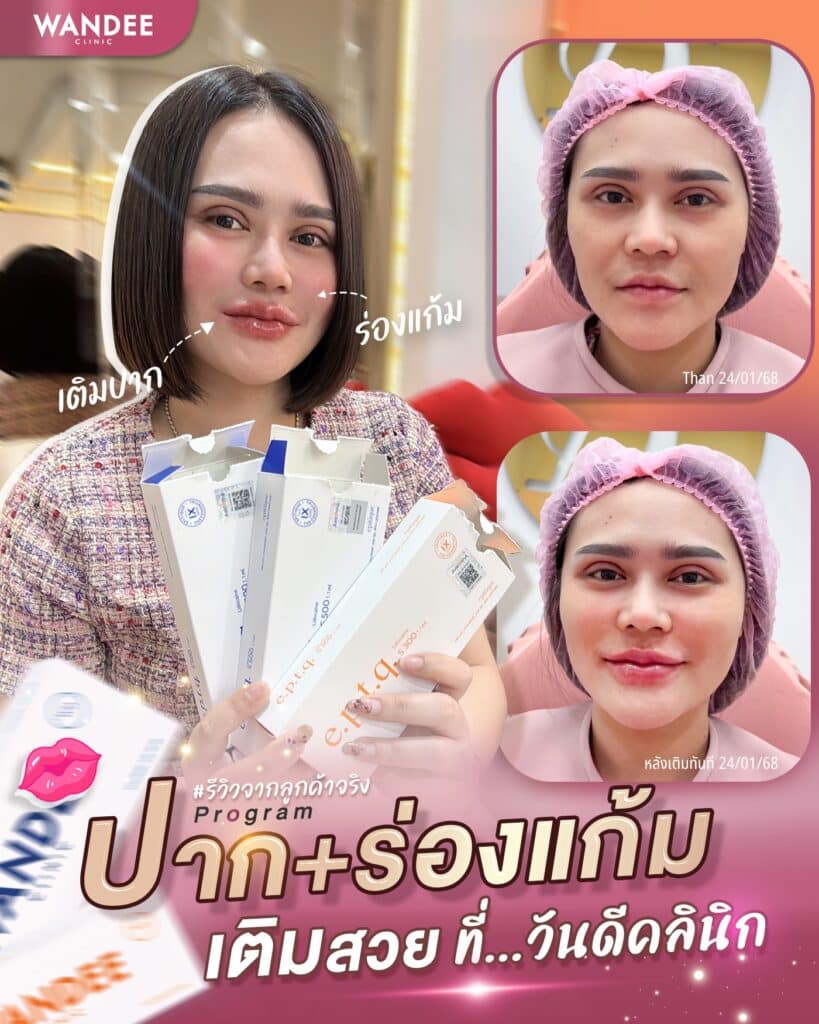 รีวิวจากลูกค้า เติมปาก + เติมร่องแก้ม ด้วย 𝗣𝗿𝗼𝗴𝗿𝗮𝗺 𝗙𝗶𝗹𝗹𝗲𝗿 ปากปัง