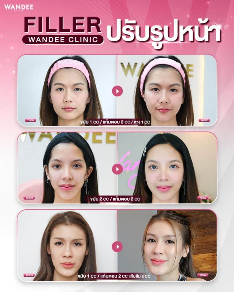 Ultra V Hyal Filler คืออะไร? ฟิลเลอร์น้องใหม่มาแรง สัญชาติเกาหลี