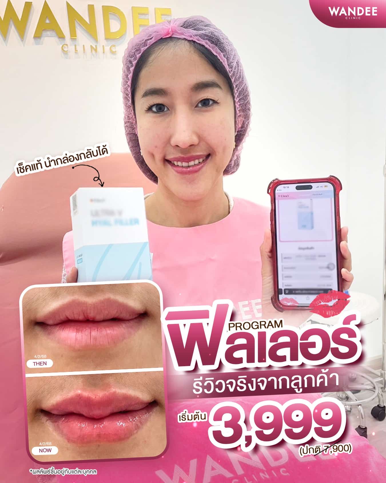 Ultra V Hyal Filler คืออะไร? ฟิลเลอร์น้องใหม่มาแรง สัญชาติเกาหลี