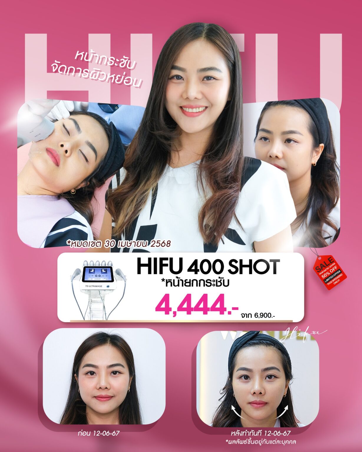 𝗣𝗿𝗼𝗴𝗿𝗮𝗺 𝗛𝗶𝗳𝘂 ยกหน้าแน่น ยกหน้า 𝗩 เสริมความมั่นใจให้หน้าเฟิร์มต้องที่ 𝗪𝗮𝗻𝗱𝗲𝗲 𝗖𝗹𝗶𝗻𝗶𝗰 นะค๊า ...